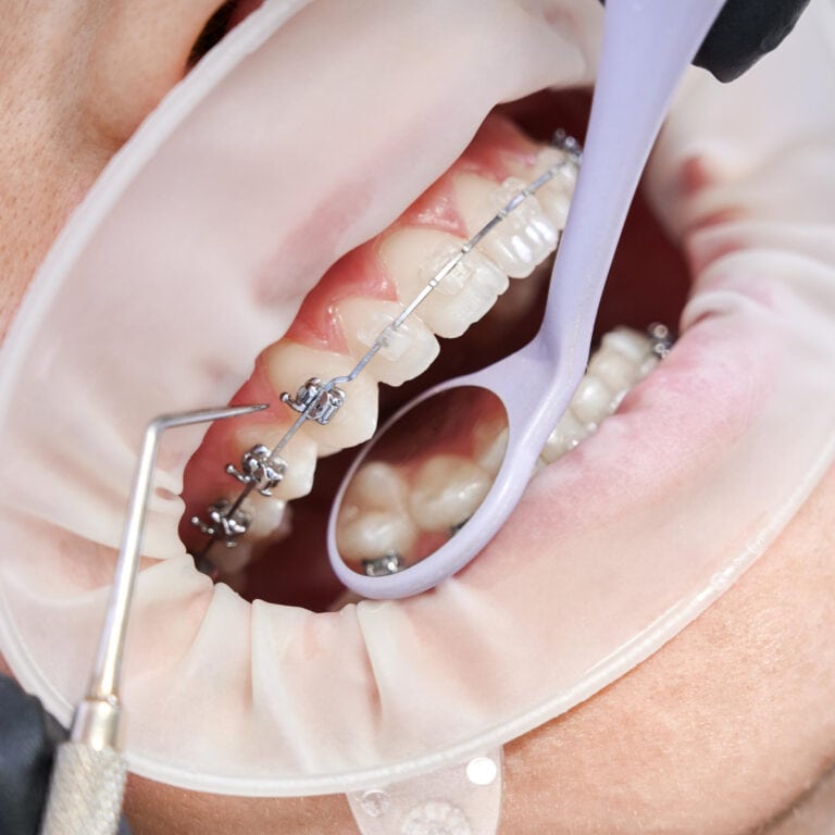 Braces For Kids Edison, NJ - Smile Solutions Orthodontics